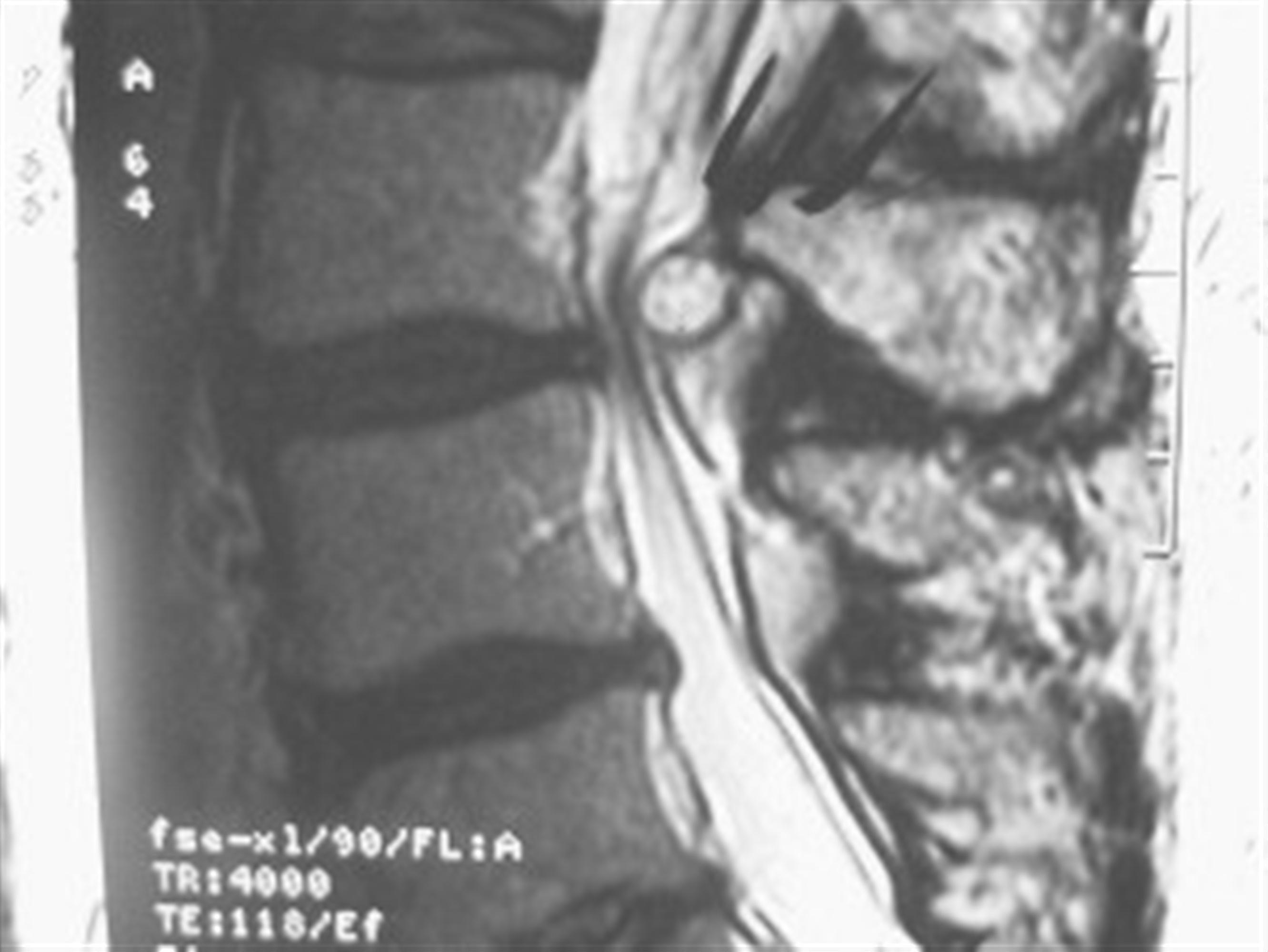 Synovial Facet Cyst Spine Orthobullets